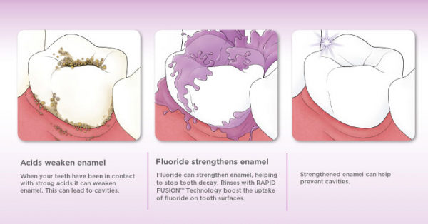 Fluoride and Decay Prevention | The Smile Makers